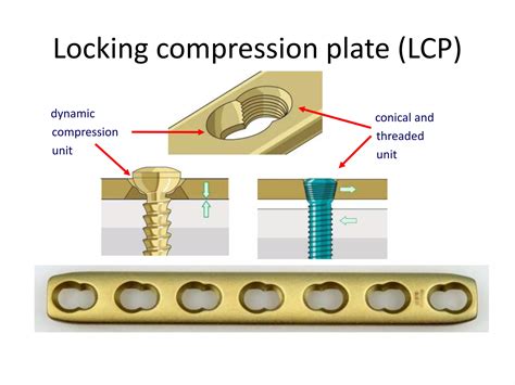 Principles Of Locking Compression Plates Pptx First Aid Injuries Principles Of Locking Compression Plates Pptx First Aid Injuries