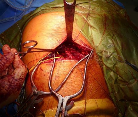 Hamstring Injuries Mysurgeons