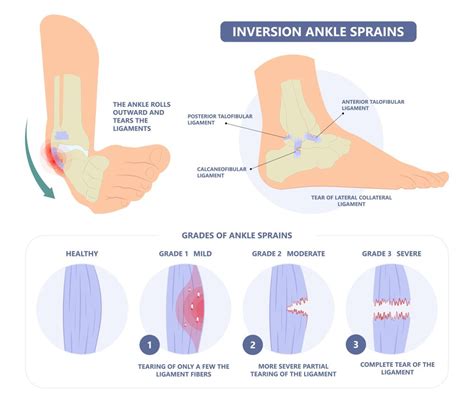 Ankle Injuries In Volleyball Rehab 49