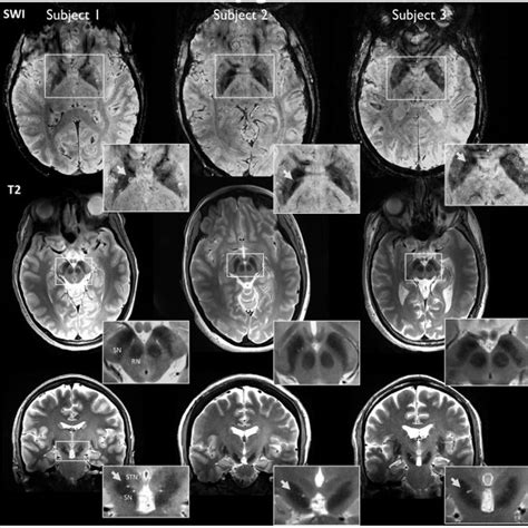 Top Row Axial High Resolution Susceptibility Weighted Images Swi In Download Scientific