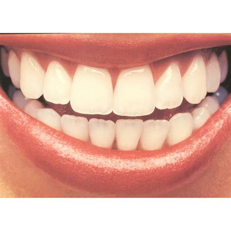 Invisalign Refinements Why Its Needed Medland Orthodontics