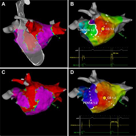 Pulsed Field Ablation Of A Persistent Left Superior Vena Cava In Recurrent Paroxysmal Atrial