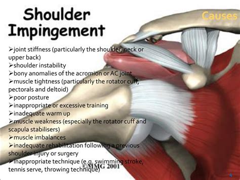 Ppt Shoulder Impingement Syndrome Powerpoint Presentation Free