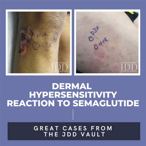 Semaglutide Rash Archives Next Steps In Dermatology
