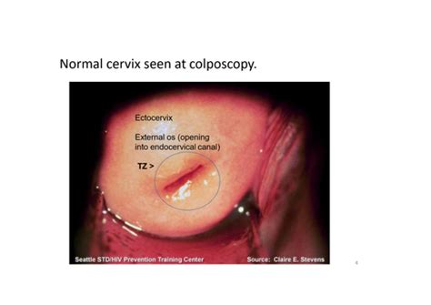 Cervical Intraepithelial Neoplasia Flashcards Quizlet