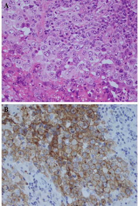 Excisional Biopsy On The Contralateral Axillary Lymph Node A And B Download Scientific Diagram