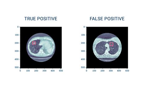 Using Medical Image Processing Ai For Lung Cancer Early Detection Azoft