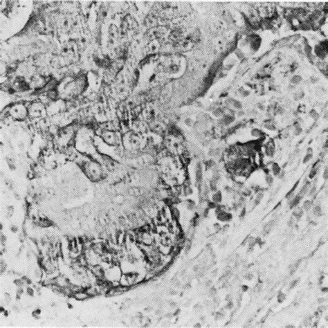 Grimelius Positive Cells In The Axillary Metastatic Tumour X 175 Download High Resolution