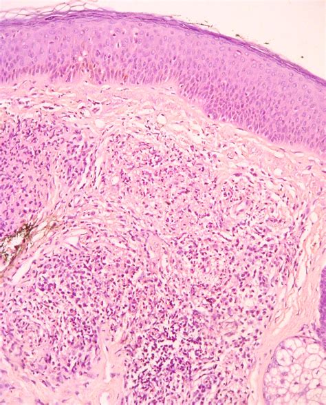 Dermatopatologia Para Iniciantes Granulomas