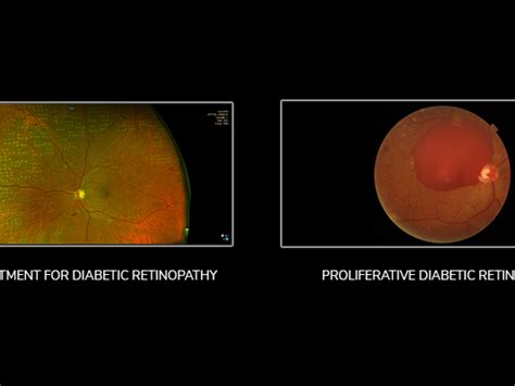Hypertensive Retinopathy Vs Diabetic Retinopathy