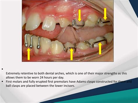 Twin Block Appliance In Orthodontics Pptx