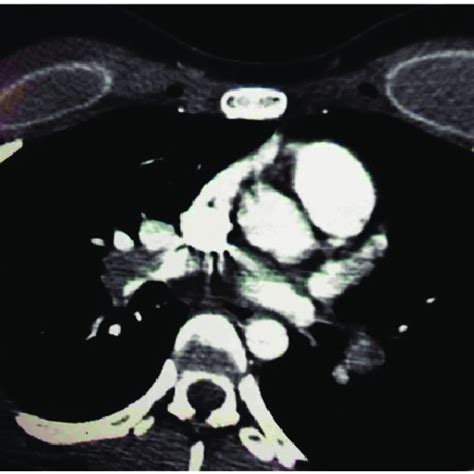 Axial Angio Ct Image Showing Bilateral Pulmonary Embolism And The