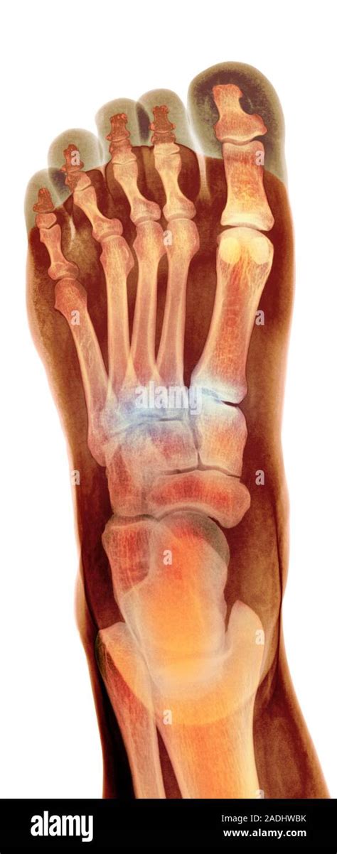 Crushed Broken Foot Coloured X Ray Of The Foot Of An Adult Woman Showing Fractures To The
