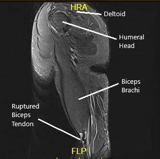 Distal Bicep Tendon Mri