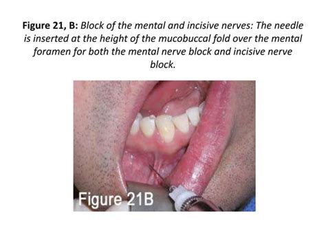 Mandibular Nerve Block Pptx