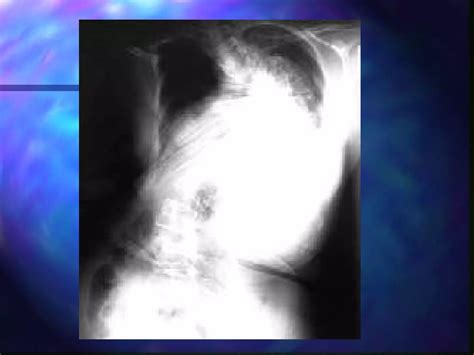 Restrictive Lung Disease Ppt