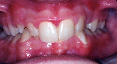 7 Types Of Bite Problems And Their Orthodontic Solutions American
