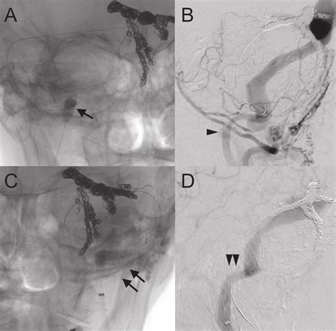 A Frontal Projection Of Fluoroscopic Image During Balloon Dilatation Download Scientific