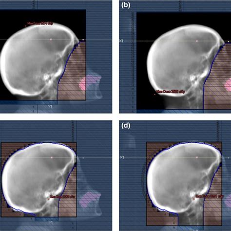 Example Of Field Aperture Options A Traditional Whole‐brain Download Scientific Diagram