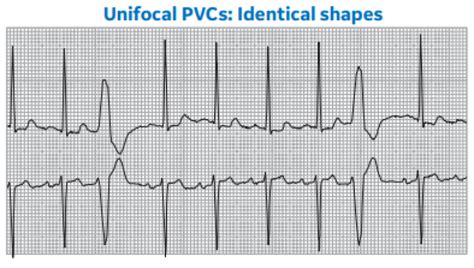 Arrhythmia Recognition Part 2 Clinical View