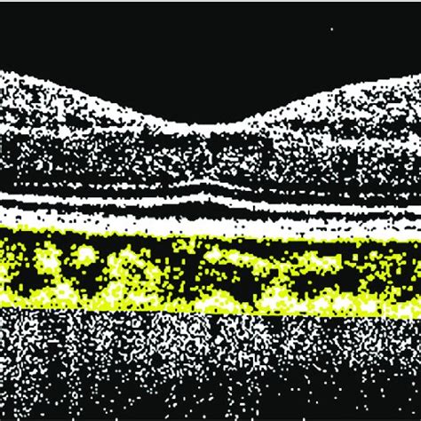 Post Acquisition Spectral Domain Optical Coherence Tomography Image Download Scientific Diagram