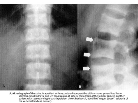 Hyperparathyroidism Pptx