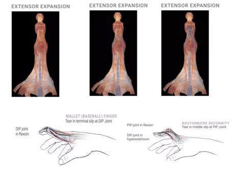 Extensor Tendon Injuries Hand Pptx