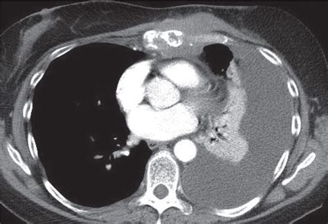Atelectasis Radiology Key