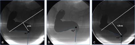 Defecating Proctogram Results