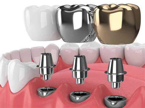 Dental Implants Easton Dental