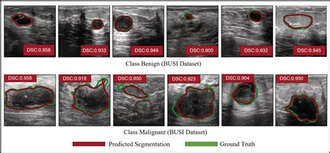 The Classwise Comparisons Of The Predicted Lesion From The Proposed Download Scientific