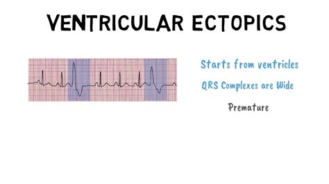 Meaning Of Ventricular Ectopy At Betty Love Blog