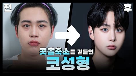 남자코성형 코성형 콧볼축소👃 그리고 이것저것 곁들인 후기 ｜남자코수술 콧볼축소 코성형전후｜서울아이성형외과 Youtube
