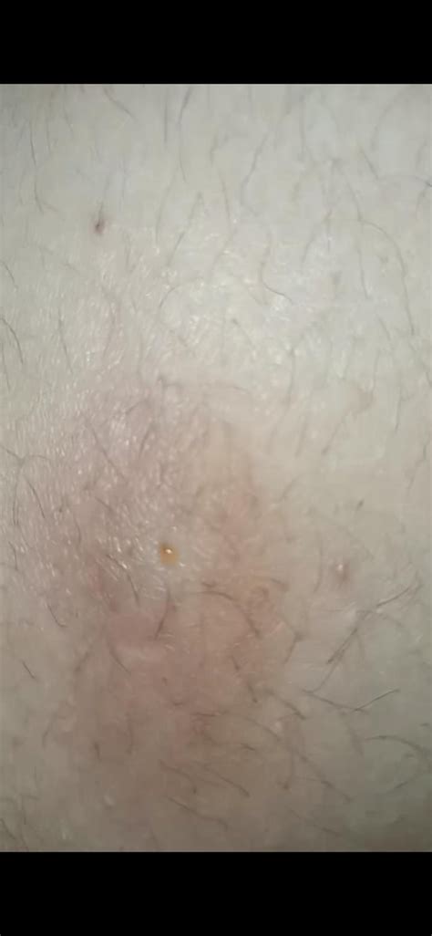Pus Is Leaking From The Tiny Hole My Skin Feels Hard In That Area And