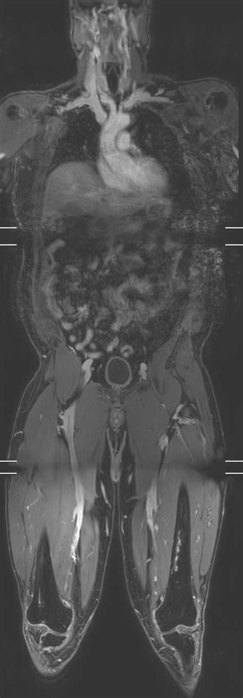 Last One For Today You May Have Never Seen Plexiform Lesion Of Nutrient Nerve Ocad