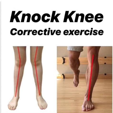 Fluid Retention Joint Hypermobility And My Knees The Hypermobile Yogi