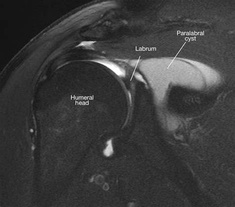 My Shoulder Superior Labrum Is Torn Do I Need Surgery Shoulder And Elbow