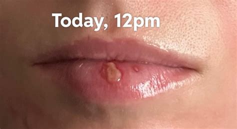 Does This Look Like A Cold Sore Just Looking For Experiential