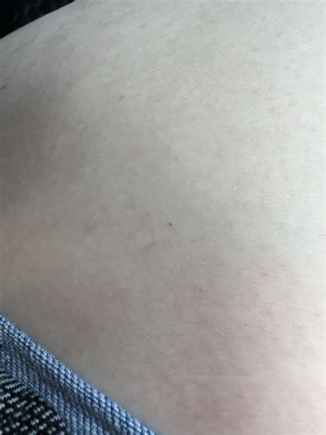 Is This A Bedbug Bite Rpestcontrol