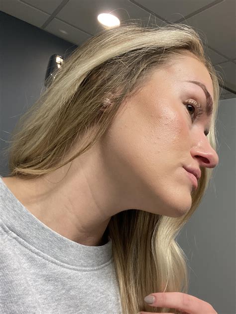 Acne Started In Sept Oct Due To A Psych Med Been On Doxycycline 3 Adapalene Used 2 3x