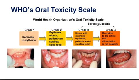 Oral Mucositis At Emaze Presentation