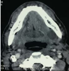Sialocele A Rare Entity Following Submandibular Gland Excision