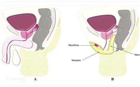عمل تغییر جنسیت سخت است چگونه انجام میشود و چه عوارضی دارد
