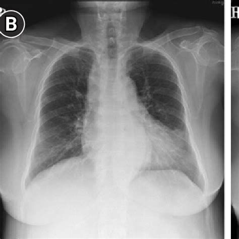 Ultrasonographic Gastric Antrum Measurement A Antrum Download Scientific Diagram