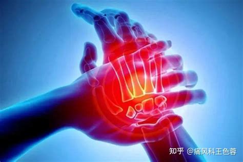 “三分治，七分养”，类风湿患者日常应该做的五件事 知乎