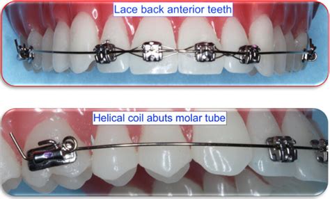 Julys Tip Orthodontic Loops In Straight Wire System Part Ii Helical