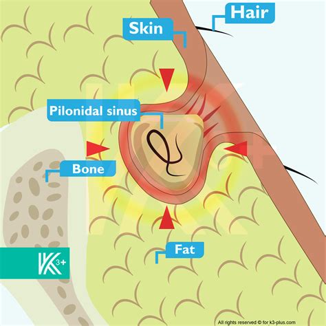 Pilonidal Cyst Diagram