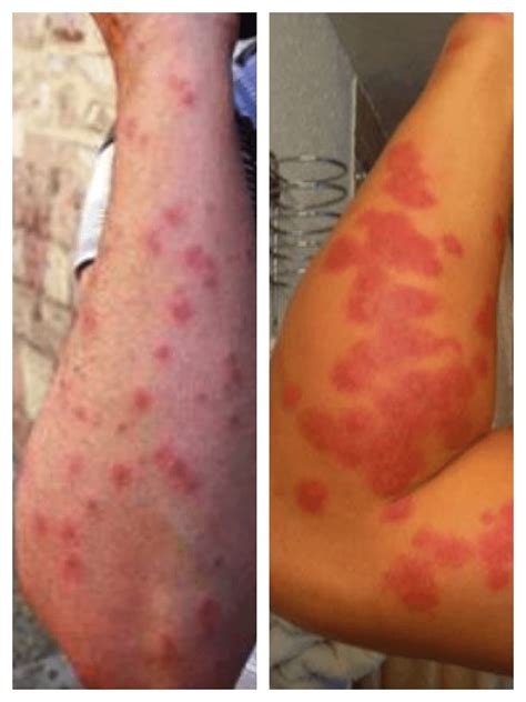 Bed Bug Bite Swelling