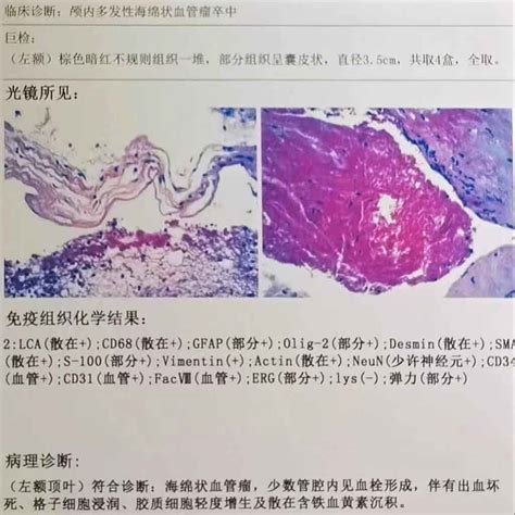 颅内多发大型海绵状血管瘤卒中 海绵状血管瘤 脑卒中 血肿 健康界
