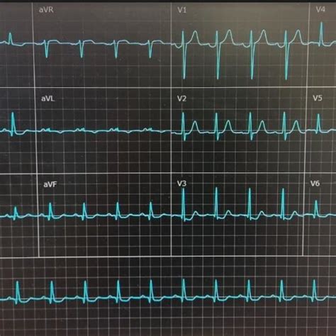 Electrocardiogram Of Normal Sinus Rhythm With Diffuse St Segment Download Scientific Diagram